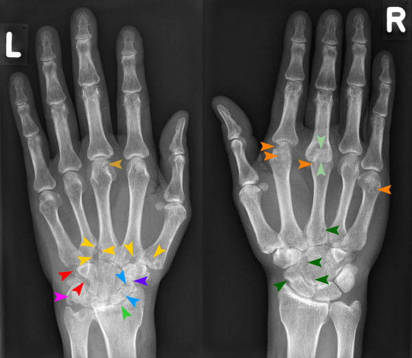 Radiologische Zeichen sind: