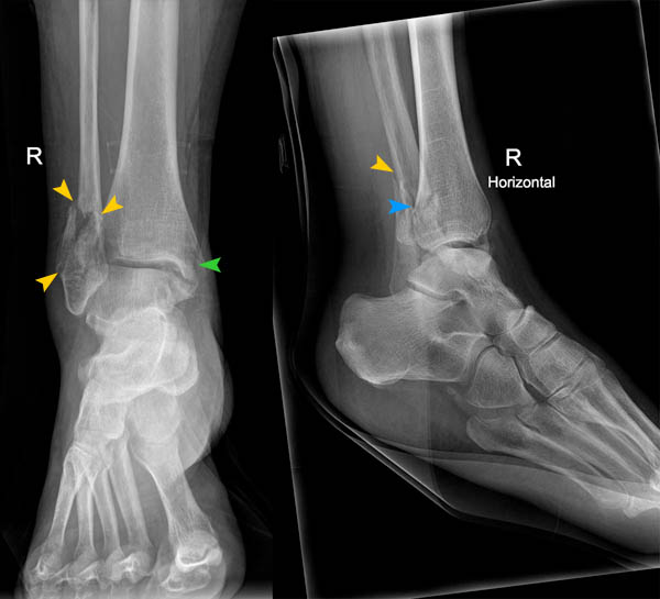 Fuss dp/schräg rechts d1
