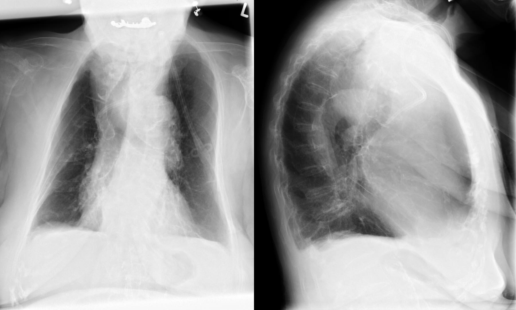 Λ Bild 1/4 - Thorax pa/seitl.: Gewichtszunahme unter Dialyse, 89-j. Frau Λ