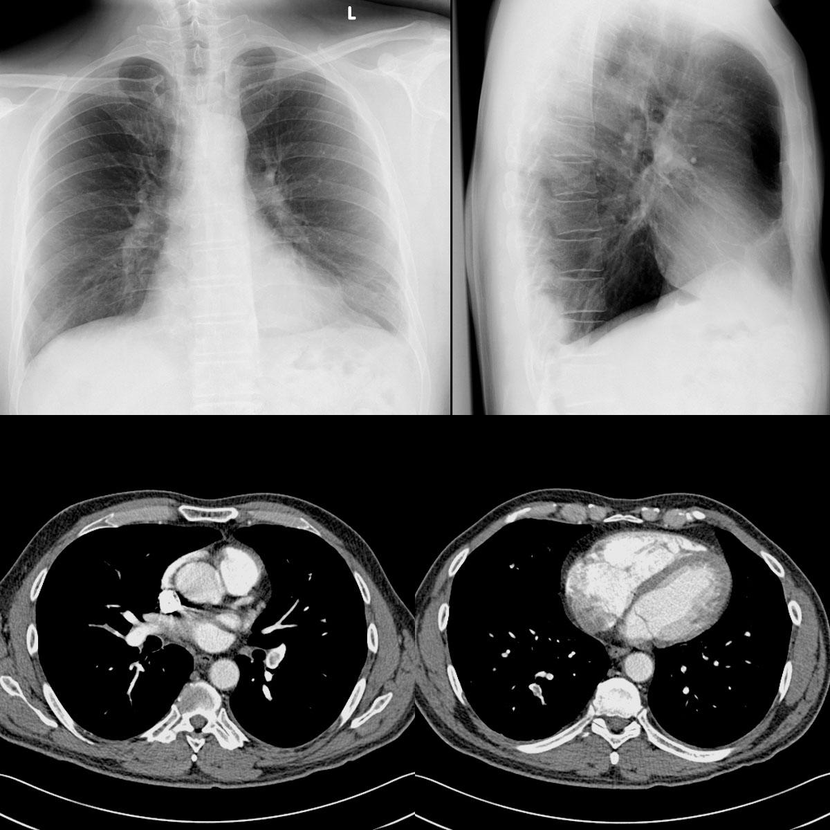 Bild 4/9 - Thorax pa/seitl. + CT: Thoraxschmerzen, 54-j. Mann
