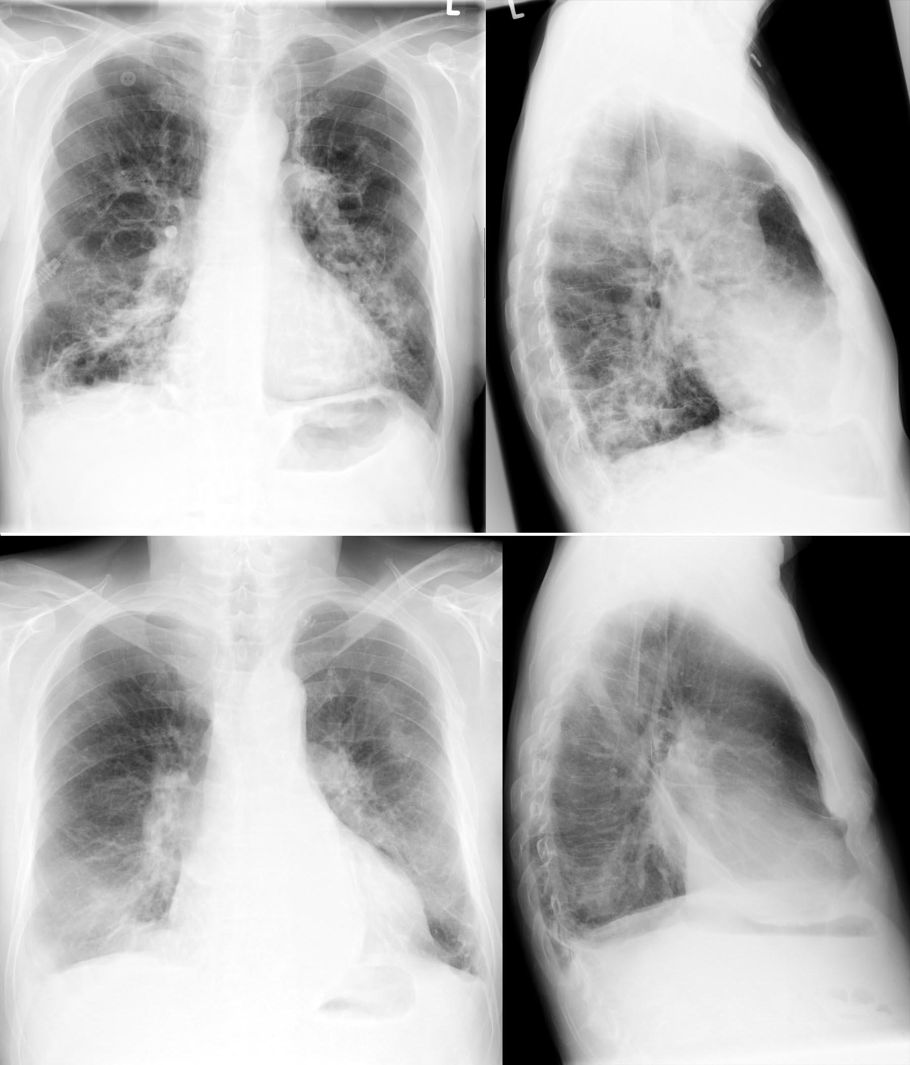 Λ Bild 2/4 - Thorax pa/seitl.: Zustand vor und nach ...