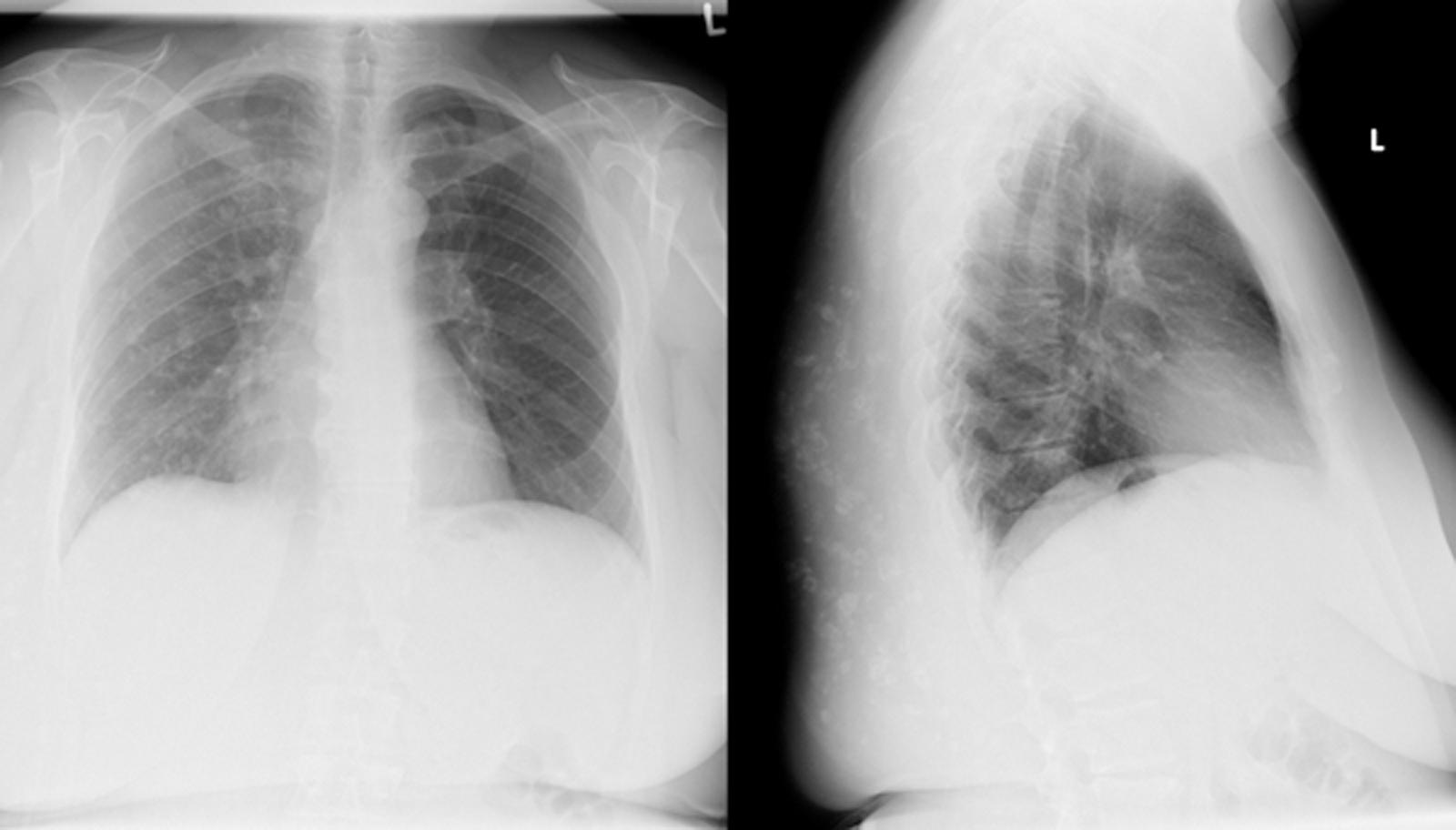 Bild 1/19 - Thorax pa/seitl.: Unklare Schwellung am Rücken, 41-j. Frau