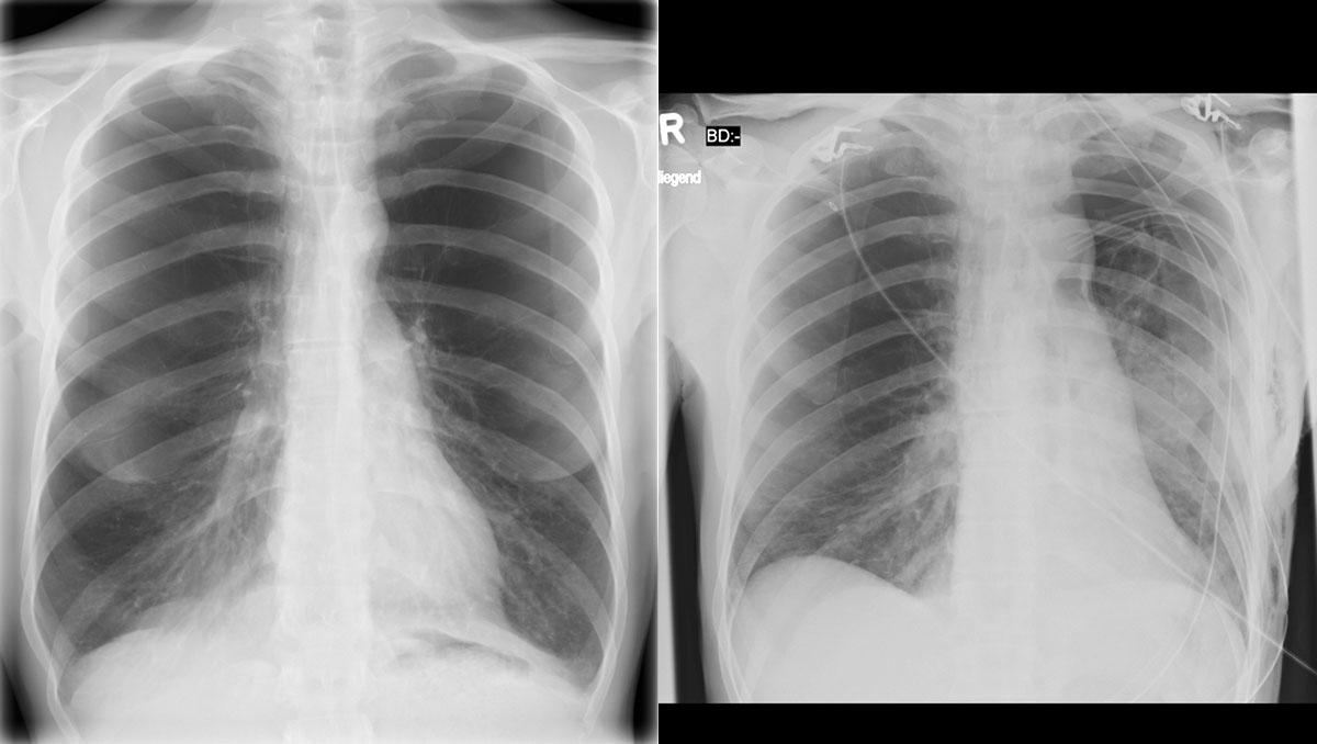Λ Bild 8/10 - Thorax pa: Prä- und postop. Zustand bei OL-Resektion li, 41-j. Frau Λ