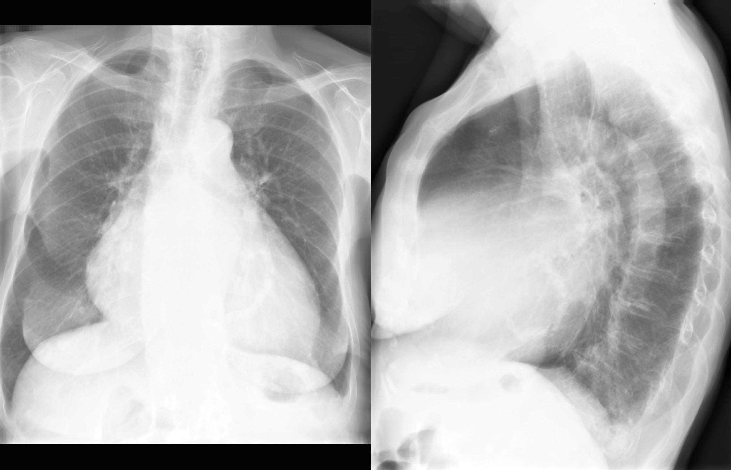 Λ Bild 1/60 - Thorax pa/seitl.: Präop. Routineuntersuchung vor ACBP ...