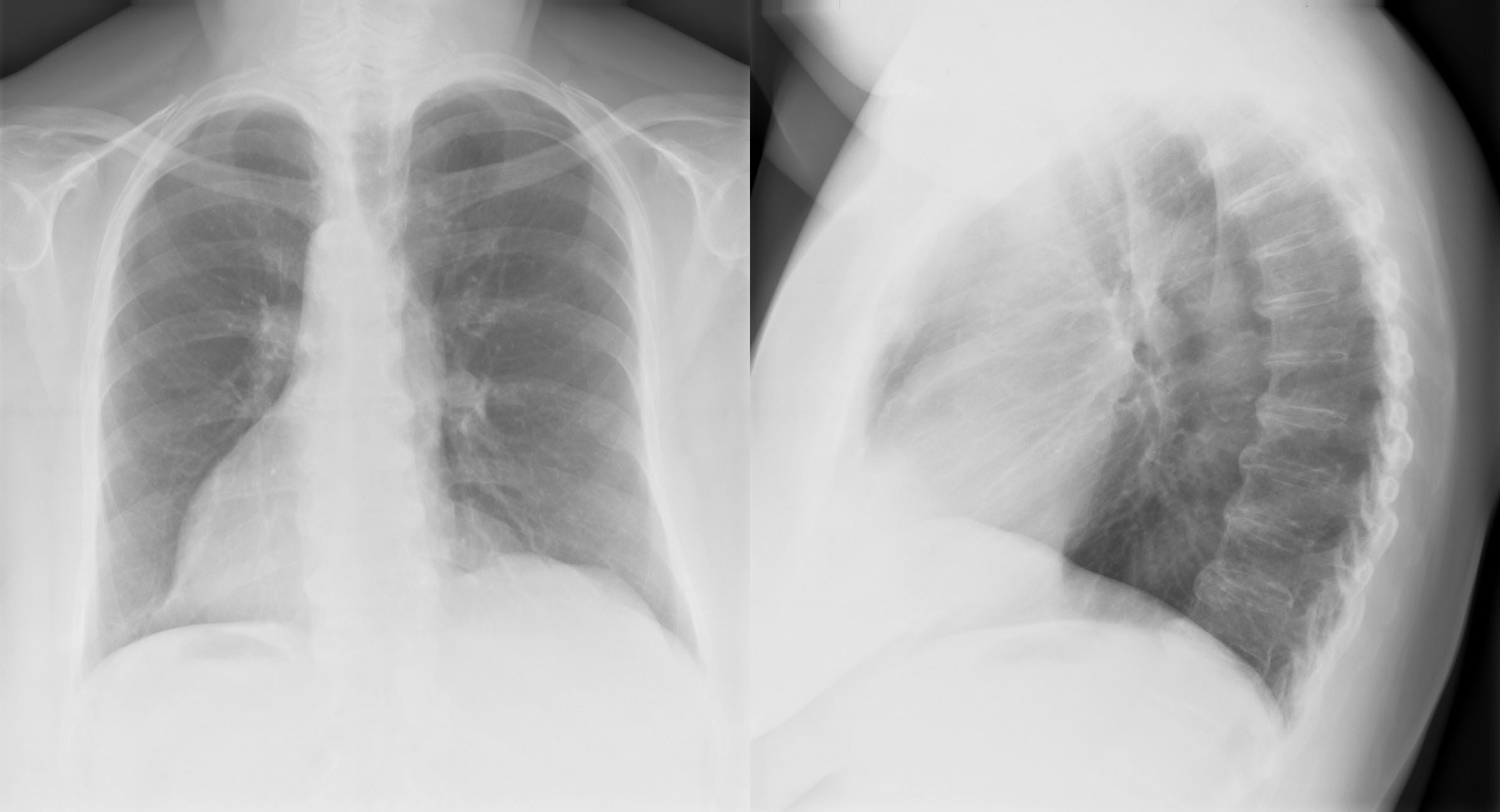 Λ Bild 25/60 - Thorax pa/seitl.: Routine­untersuchung vor Blasenoperation Λ