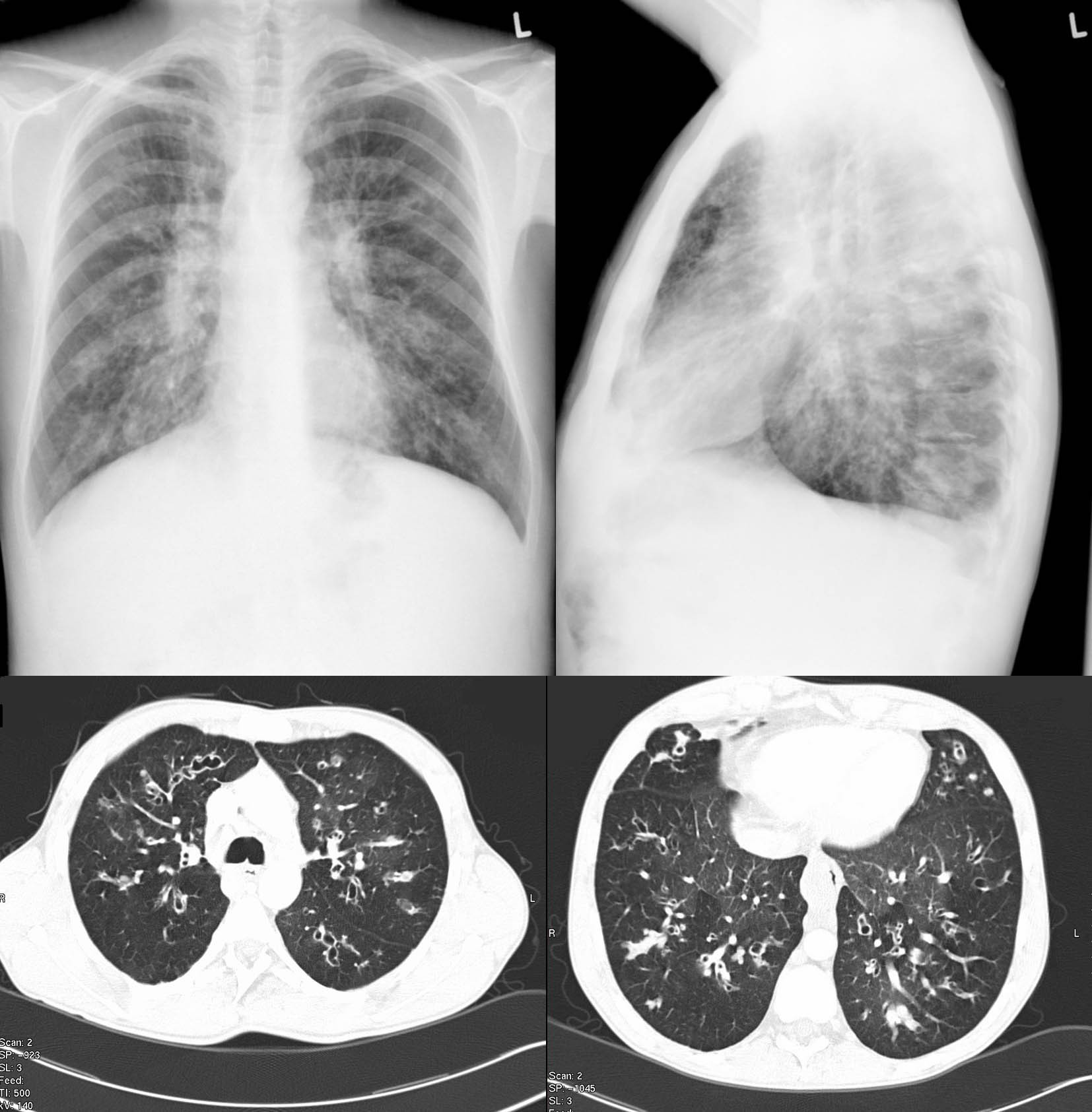 Λ Bild 27/60 - Thorax pa/seitl.: Zystische Fibrose Λ