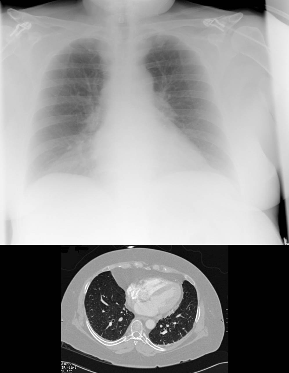 Bild 26/68 - Thorax ap liegend + CT: Synkope
