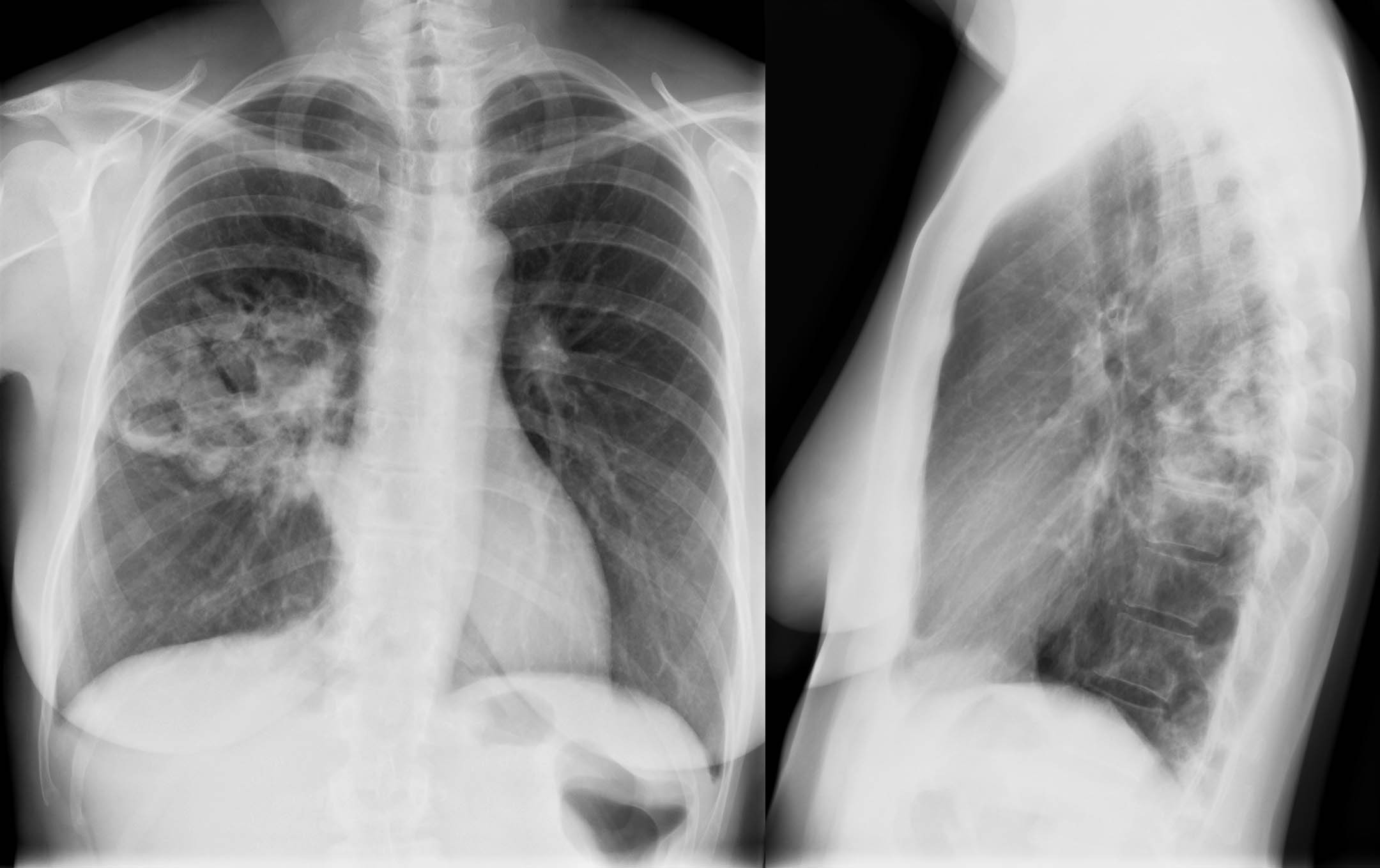 Λ Bild 14/20 - Thorax pa/seitl.: Rezidivierende pulmonale Infekte Λ