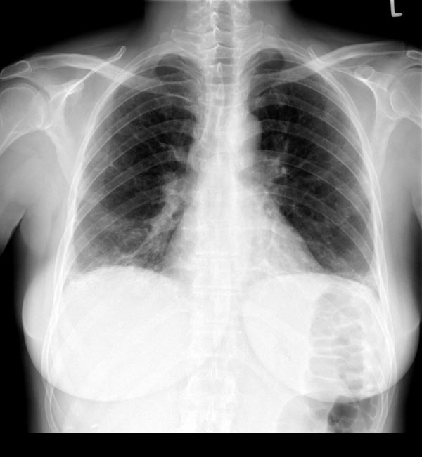 wenn nicht wie in diesem fall der ösophagus befallen und dilatiert ist ...