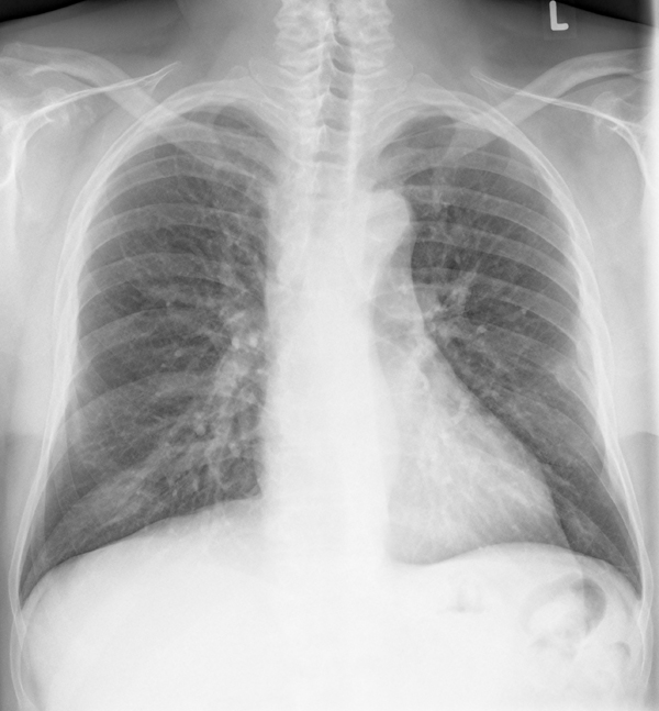 8 rippe links beurteilung alte rippenfrakturen links 7 8 rippe info ...