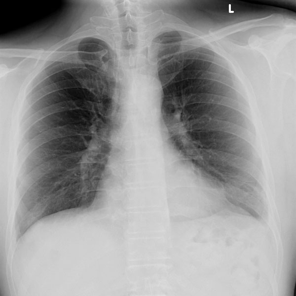 ausflußbahn rechtsherzinsuffizienz mit erweiterung der v cava superior ...