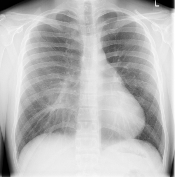 pectus excavatum mit einigen syndromen z b dem marfan syndrom info ...