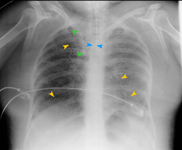 © Institut für Diagnostische Radiologie, UniversitätsSpital Zürich